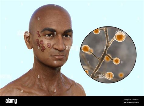 3d Illustration Of A Man With Multiple Face And Neck Lesions Caused By