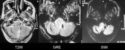 T2 Weighted Gradient Echo And Susceptibility Echo Download Scientific Diagram