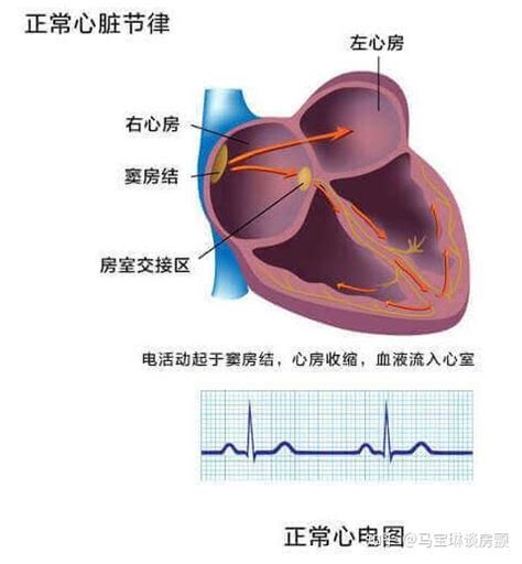 房颤总论：一文了解房颤全貌！ 知乎