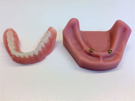 Implantaten Anne Gyselinck Tandarts