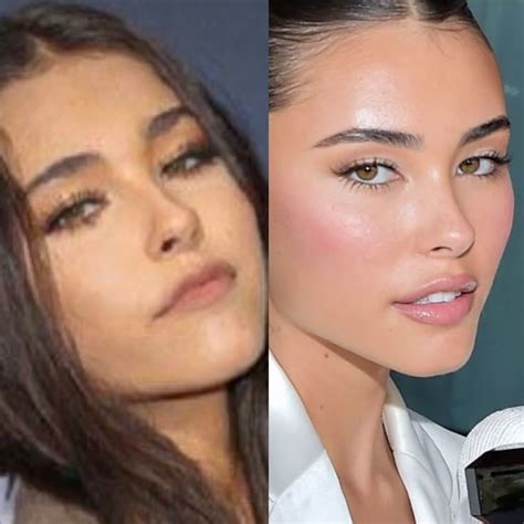 Madison Beer Plastic Surgery Chin Implant Facial Aesthetics Facial