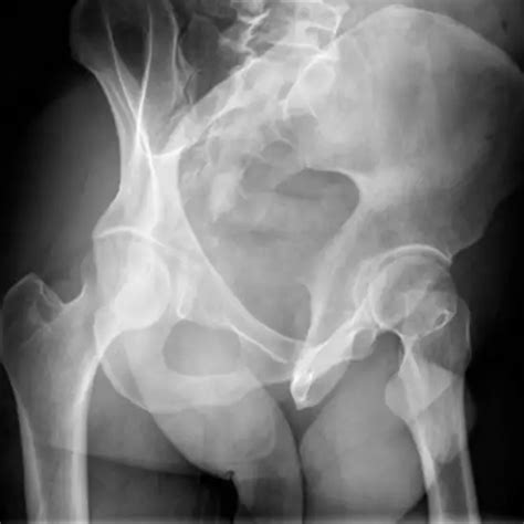 X Ray Pelvis Lateral View Test Price In Delhi Ganesh Diagnostic