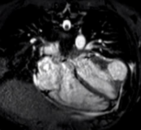 Cardiac Mr Artifacts Questions And Answers In Mri