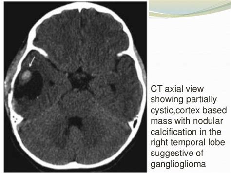 Physiological And Pathological Calcification Of Brain