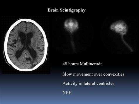 Brain Scintigraphy Brain Scintigraphy Brain Scintigraphy Brain Scintigraphy