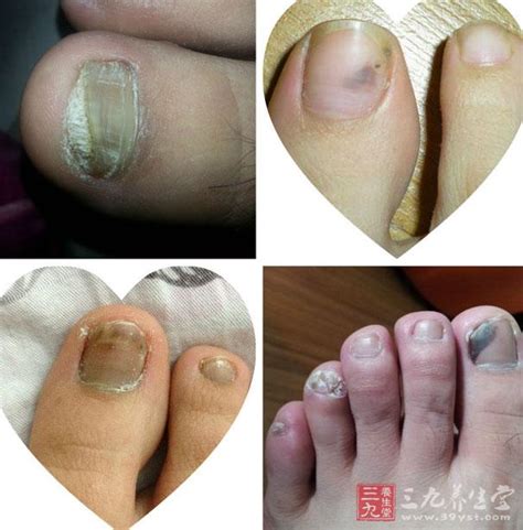 手指灰指甲 手指头灰指甲图片 手指得了灰指甲图片 大山谷图库