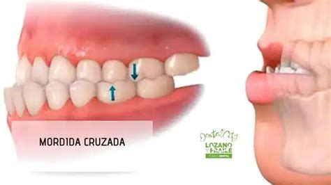 Mordida Cruzada Qué es y cómo solucionarlo Dental City Málaga