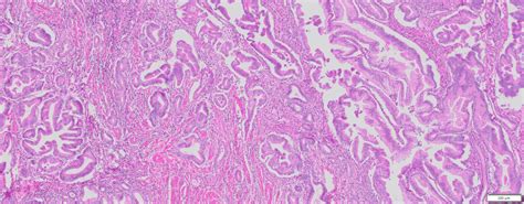 Human Pancreas Cancer Adenocarcinoma Ffpe Sections Human Pancreas Cancer Adenocarcinoma Ffpe Sections