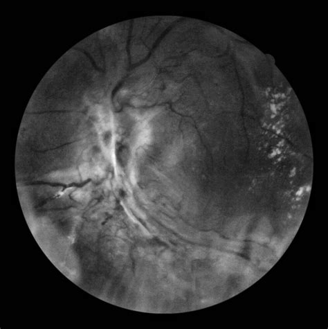 Preprocessdiabetic Retinopathy Classification Dataset By