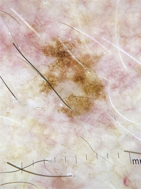 Seborrheic Keratosis Dermoscopy Stock Image C0605531 Science
