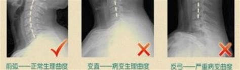 颈椎不适，报告上显示颈椎生理曲度变直或反弓，是得颈椎病了吗？ 哔哩哔哩