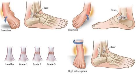 Ankle Sprain Symptoms Treatment And Recovery