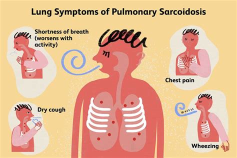 Sarcoidosis How It Develops And How It S Treated
