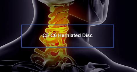 C5 C6 Herniated Disc Dr Kevin Pauza The Discseel® Procedure Inventor