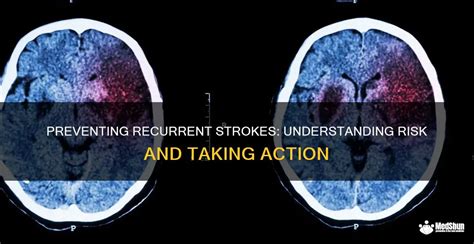 Preventing Recurrent Strokes Understanding Risk And Taking Action