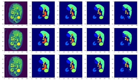 Adapting Pre Trained Vision Transformers From 2D To 3D Through Weight