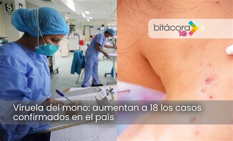 Viruela Del Mono Aumentan A 18 Los Casos Confirmados En El País