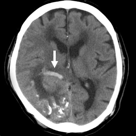 Computed Tomography 10 Days After The Initial Visit Nonenhanced Download Scientific Diagram
