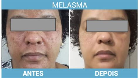 Manchas E Melasma Existe Tratamento Dermatologia Desde 1969