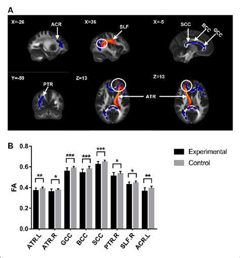 Diffusion Tensor Imaging DTI Results With Significant Difference Download Scientific