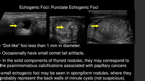 Thyroid Imaging Reporting And Data System