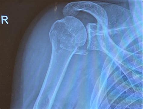 Subcapital Humerus Fracture With Bone Fragment Rbrokenbones