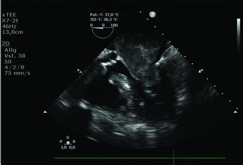 Transesophageal Echocardiography Mid Esophageal 5 Chamber View Showing