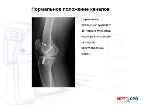 Возможности МРТ визуализации в диагностике послеоперационных осложнений