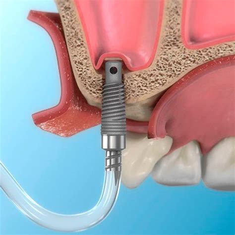 Синус лифтинг