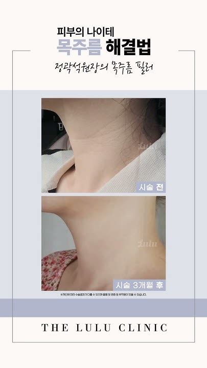 점점 깊어지는 목주름 관리하는 방법 Beforeandafter Kbeauty Koreanbeauty Youtube