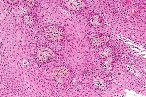 Craniopharyngioma Libre Pathology