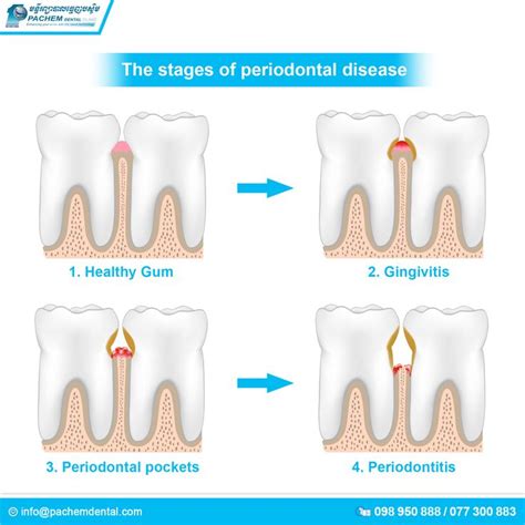 The Stages Of Periodontal Disease 1 Healthy Gum 2 Gingivitis 3