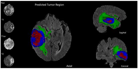 Brain Tumor Segmentation
