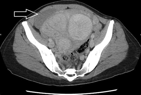 Pedunculated Subserosal Leiomyoma With Torsion A Rare Cause Medicine