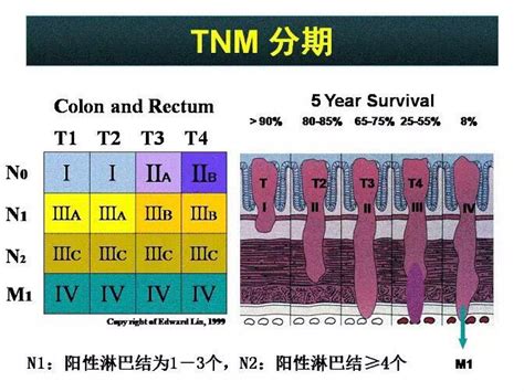 大肠癌的早、中、晚期是如何分类的凤凰网