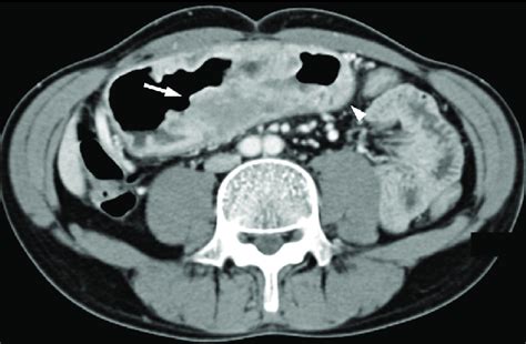 Axial Ct Scan Showing A Large Ulcerofungating Mass Arrow Involving