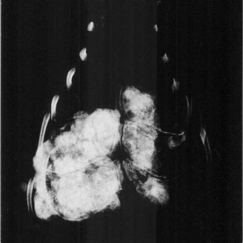 Pdf Multiple Cartilaginous Exostoses In A Cat