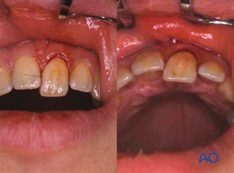 Tooth Fracture Root Fracture