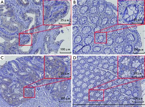 Programmed Cell Death Ligand 1 Pd L1 And Vascular Endothelial Growth