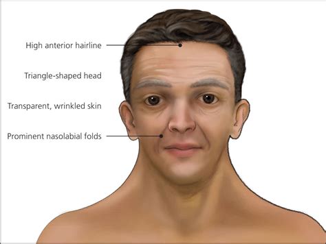 Noonan Syndrome Afp