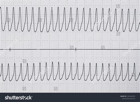 Sustained Monomorphic Ventricular Tachycardia On Hilter Foto Stock