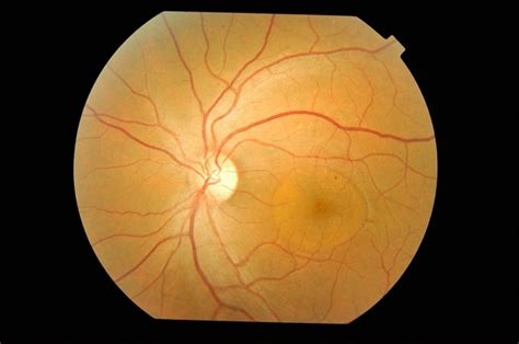 Cscr Retina Image Bank