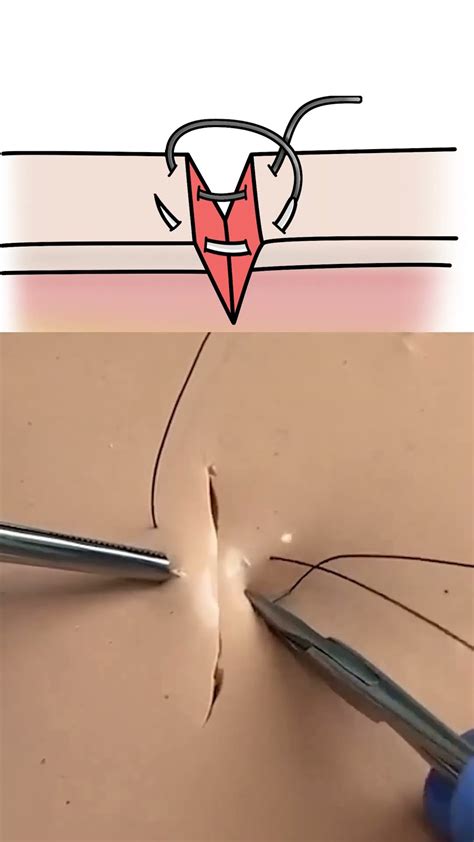Figure Of 8 Suture Youtube