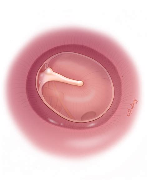 Exostoses Of The Ear Canal Oto Surgery Atlas