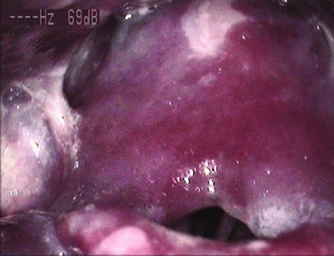 Case 1 Before Therapy With Rituximab Desquamative And Erythemathous