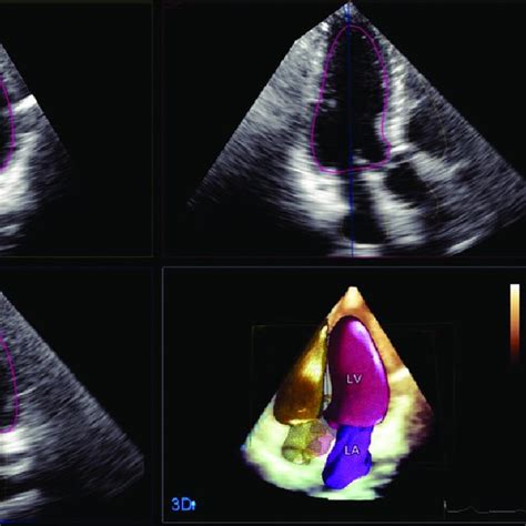 A Fully Automated Lv Endocardial Contour Tracing Using The 3d