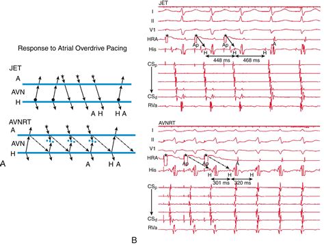 Junctional Tachycardia Clinical Tree