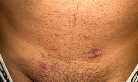 Is This A Hiv Rash Unprotected Sex Two Weeks Ago No Other Symptoms