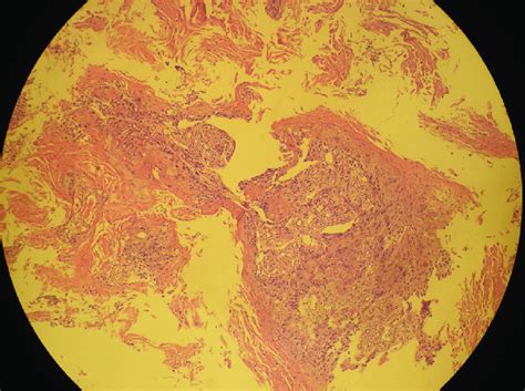 Histopathology Of Colonoscopic Biopsy From Terminal Ileal Mass Showing
