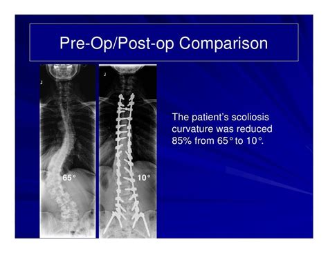 Case Review 15 Adult Scoliosis Treated With Spinal Fusion And Oteoto